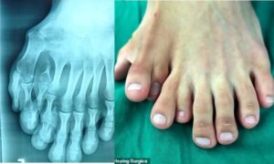 Meet Chinese man born with nine toes and how he sought help to cut off ...