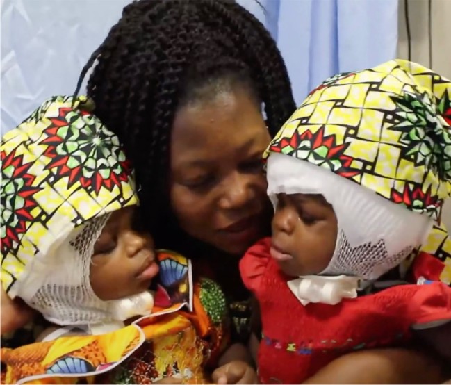 Watch heartwarming video of successful separation of twins conjoined at ...